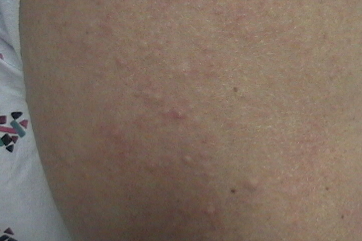Hives Urticaria & Angioedema Photos | AAAAI