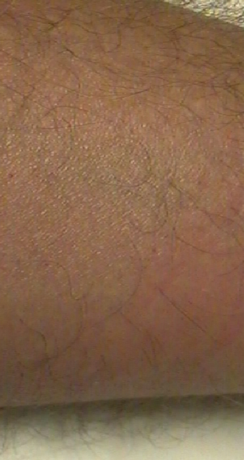 Hives Urticaria & Angioedema Photos | AAAAI