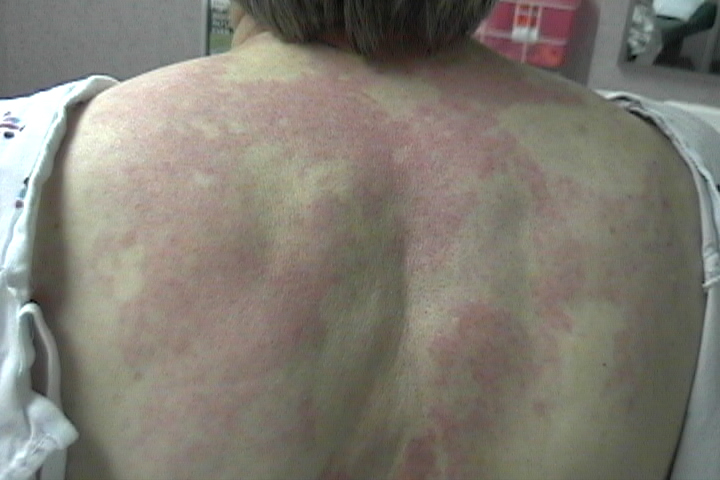 Hives Urticaria & Angioedema Photos | AAAAI