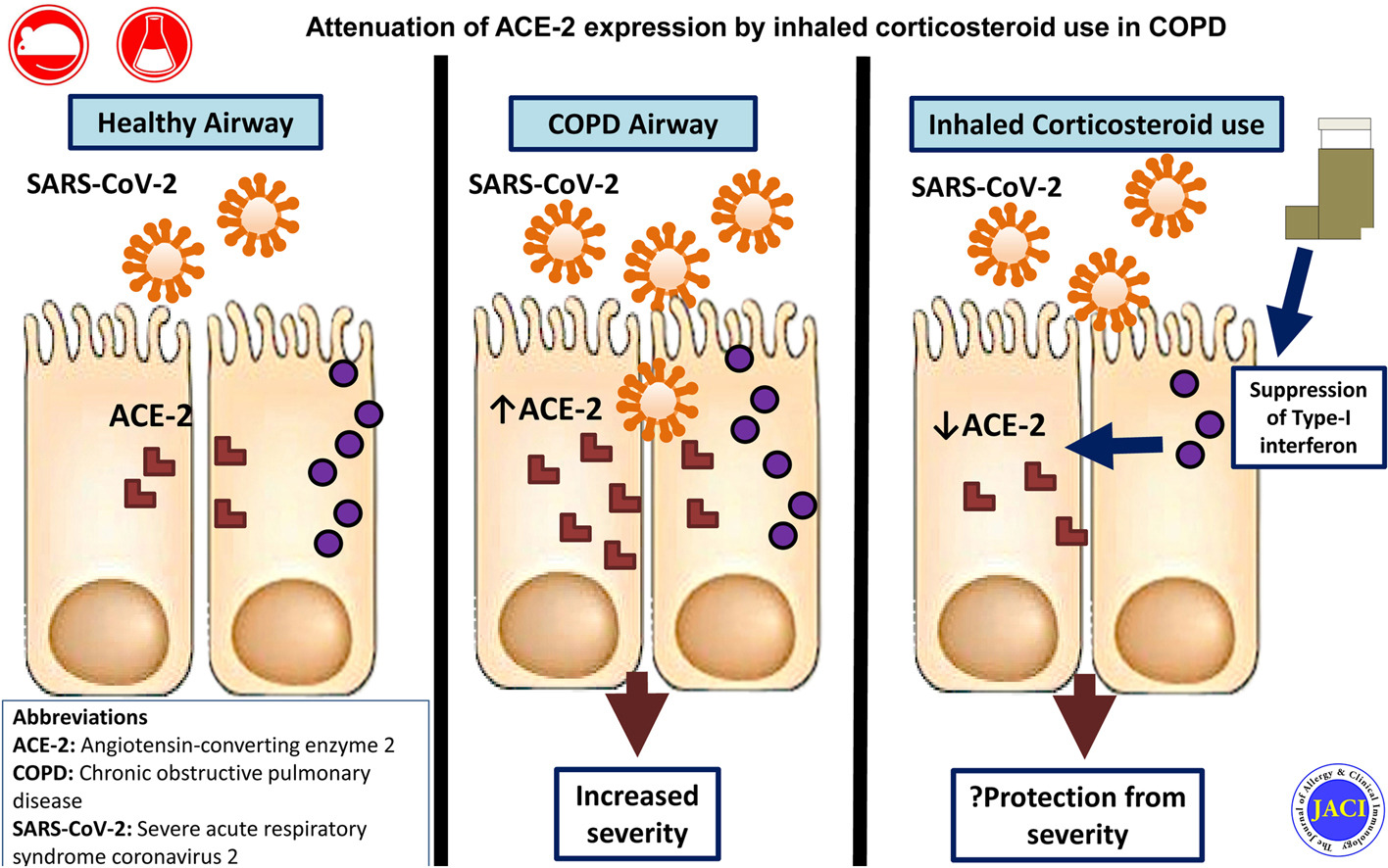 Steroid inhalers reduce receptors used by SARS-COV-2